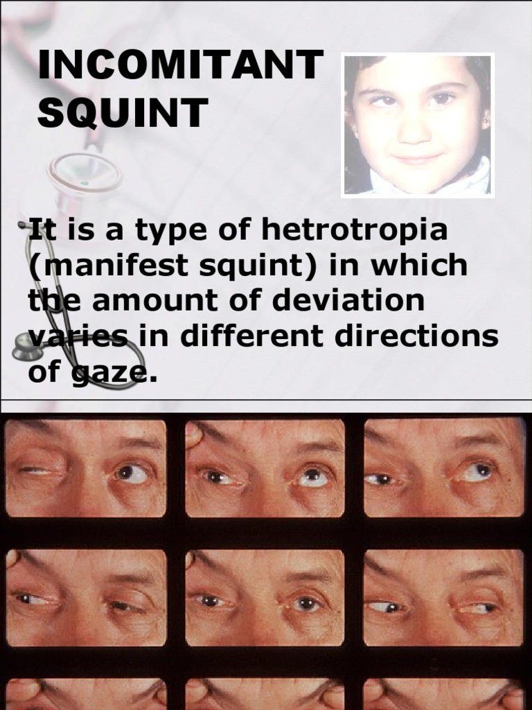 Incomitant Squint Overview and Management | PDF | Eye | Diseases Of The ...
