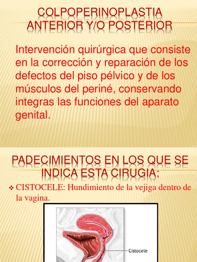 Colpoperinoplastia Anterior y | Cirugía | Cuidado de la salud