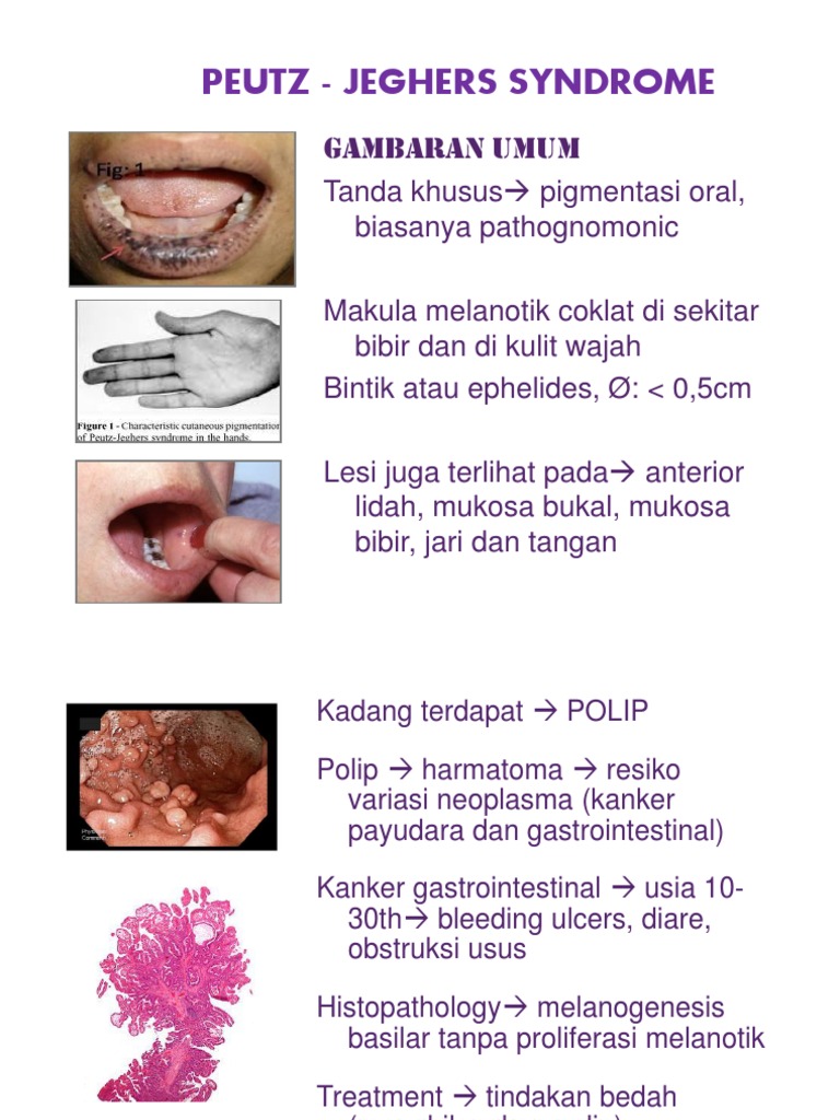 Peutz - Jeghers Syndrome | PDF