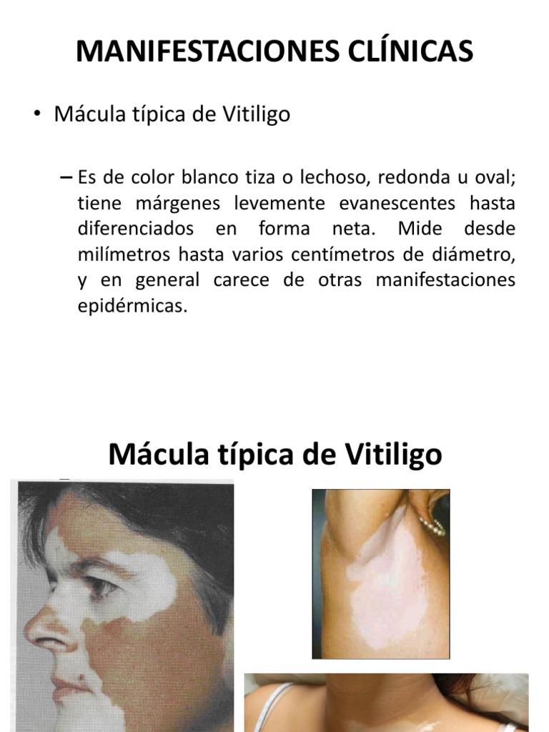 Vitiligo | PDF | Condiciones cutáneas | Medicina CLINICA