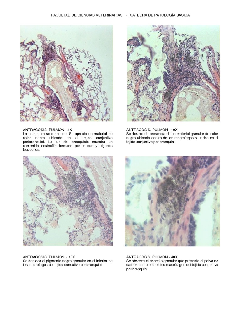 Antracosis PDF | PDF
