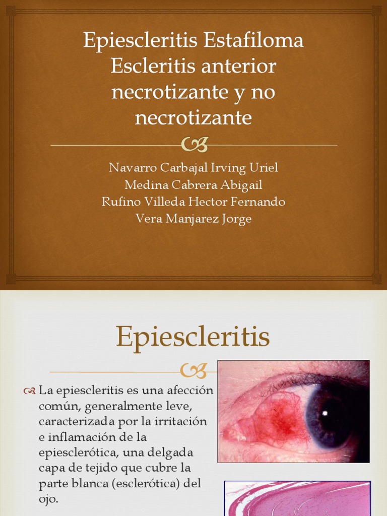 Escleritis y Epiescleritis: Guía Completa | PDF | Inflamación | Ojo humano