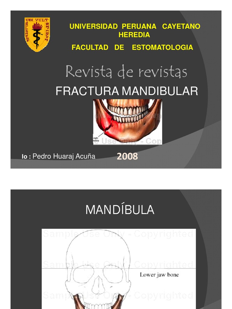 Fractura Mandibular | PDF | Enfermedades y trastornos | Medicina CLINICA
