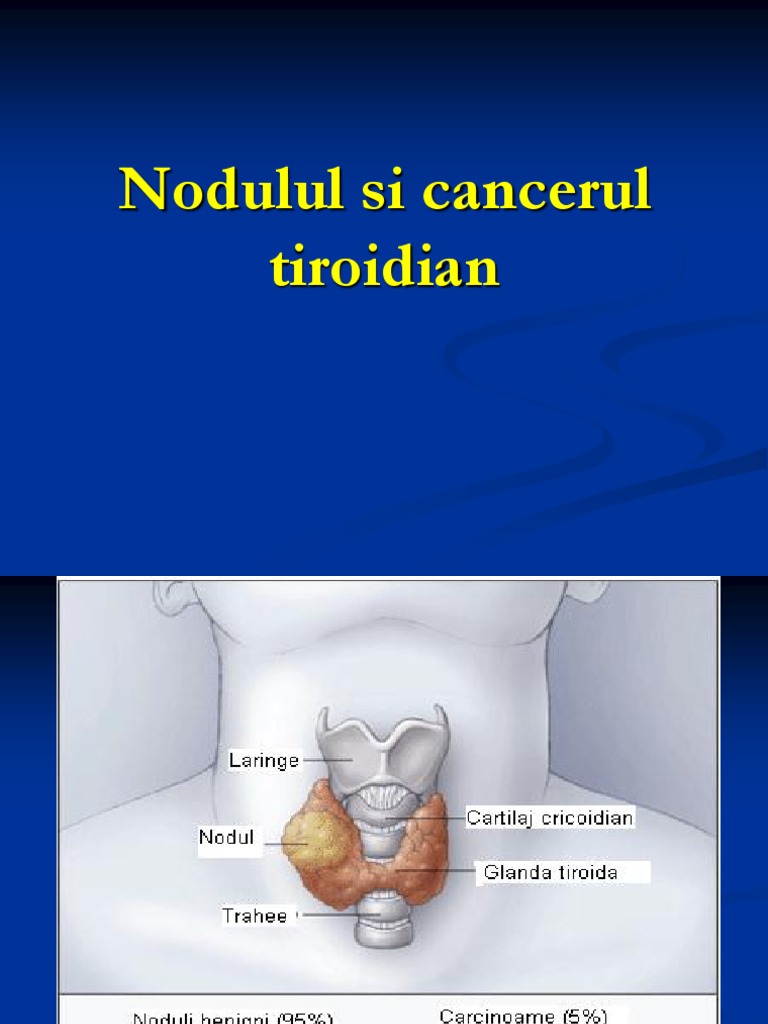 Cancerul Tiroidian | PDF