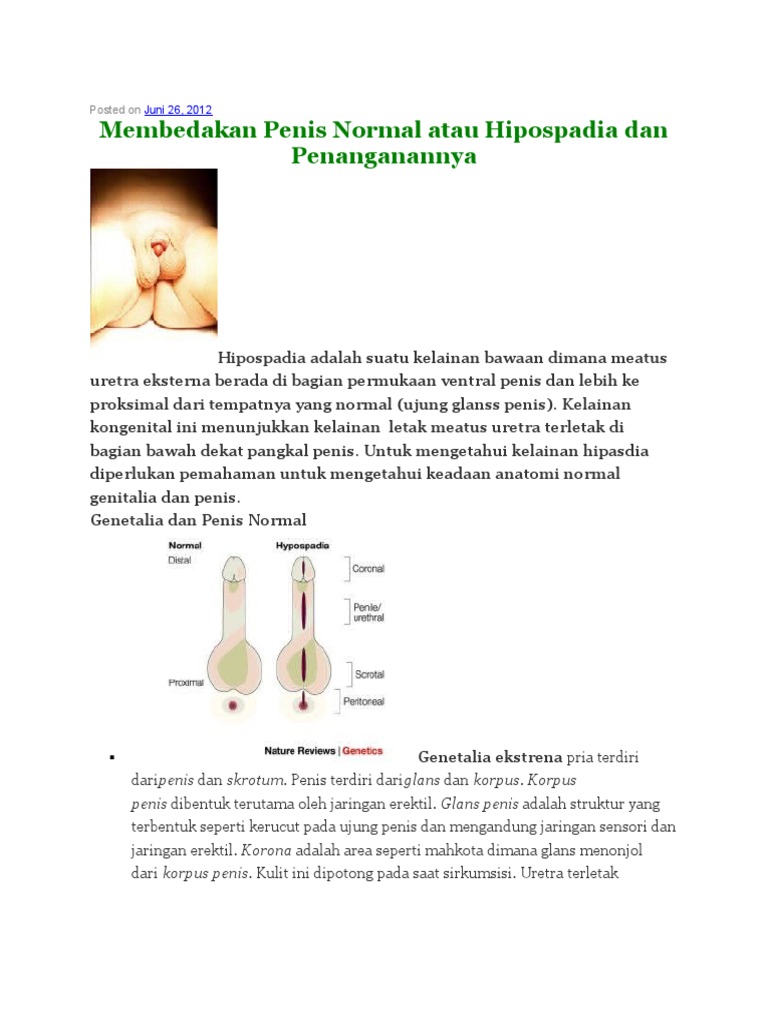 Hipospadia | PDF