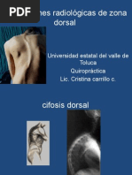 Signo de Risser | PDF | Escoliosis | Rtt