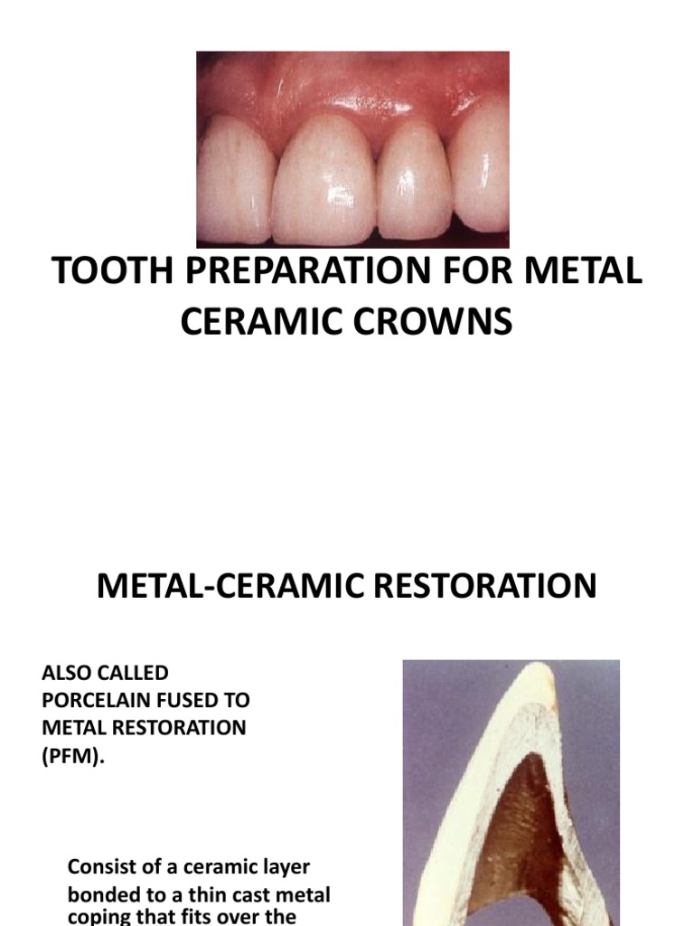 Anterior Metal-Ceramic Crown Preparation | PDF | Mouth | Dentistry