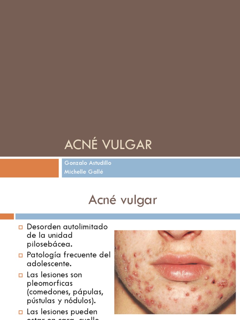 16.- Acné y rosacea | Acné común | Hormona