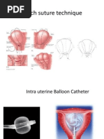 B Lynch Suturing | Uterus | Surgical Suture