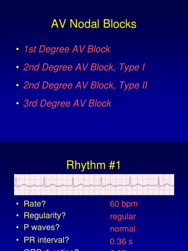 AV Block | PDF