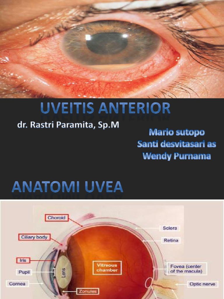 Uveitis Anterior | PDF