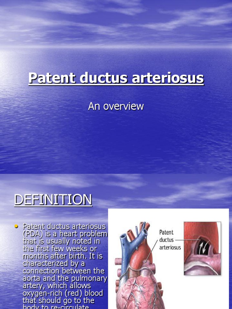 Patent Ductus Arteriosus Gross