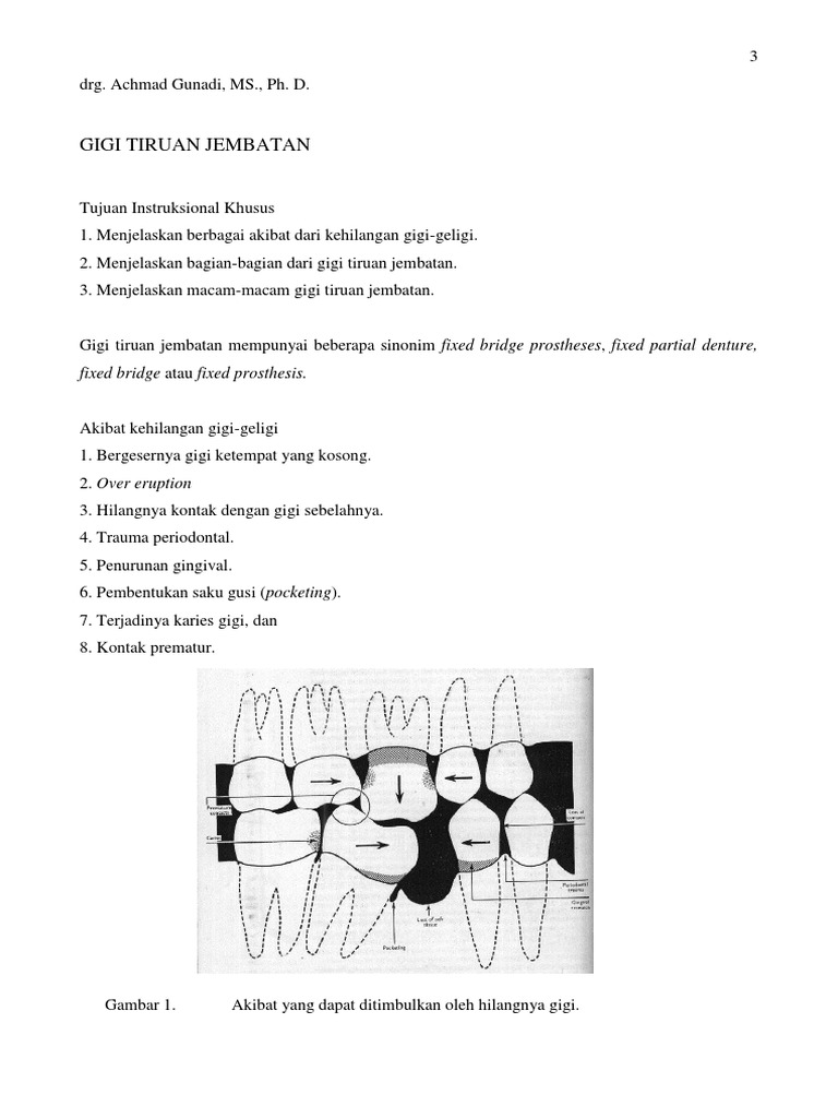 Gigi Tiruan Jembatan: Fixed Bridge Atau Fixed Prosthesis | PDF