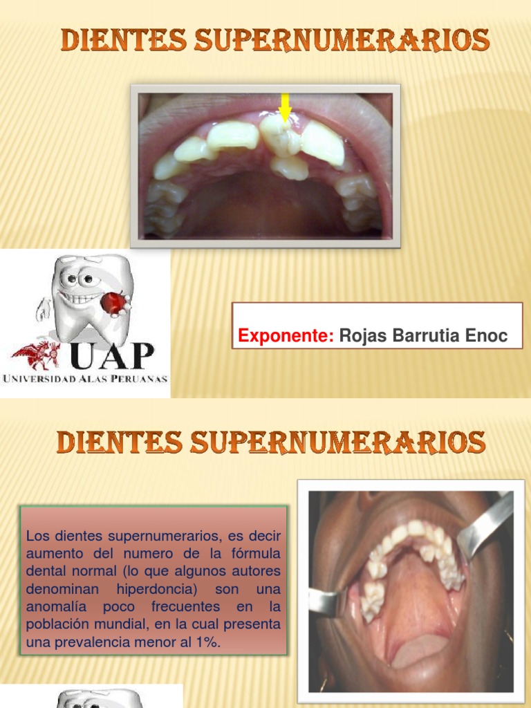Dientes Supernumerarios | PDF