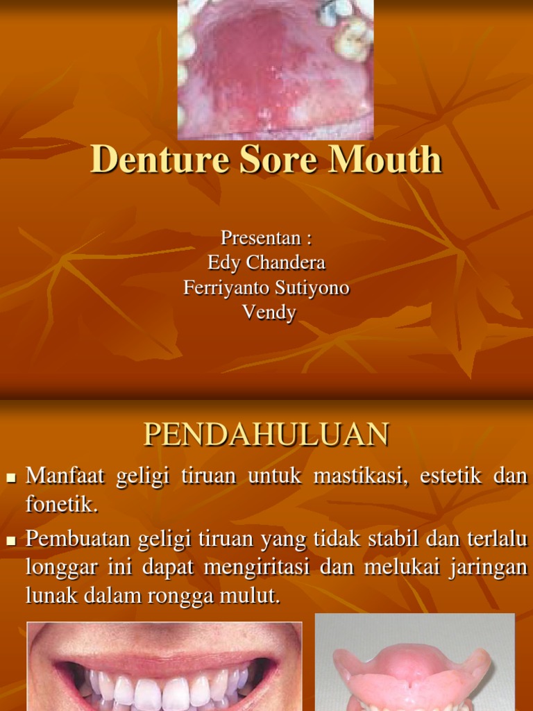 Denture Sore Mouth | PDF