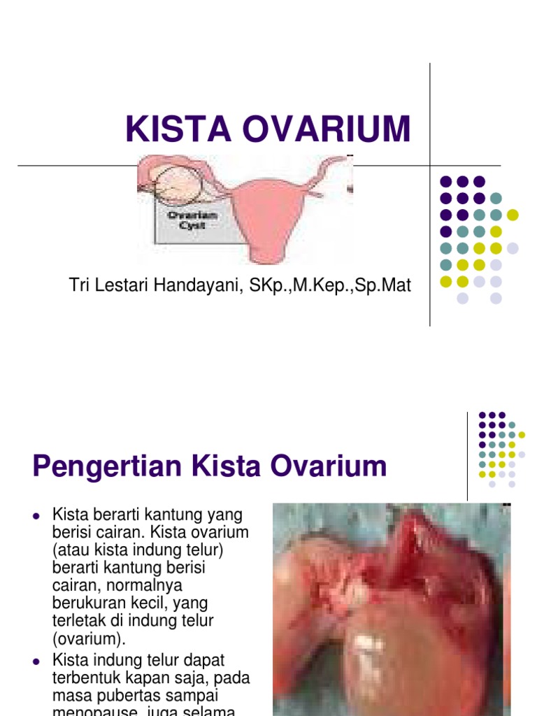 Kista Ovarium | PDF