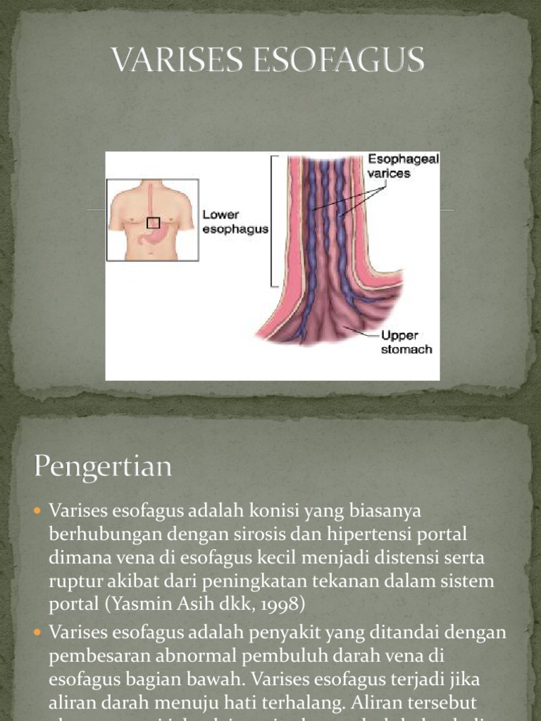 Varises Esofagus | PDF