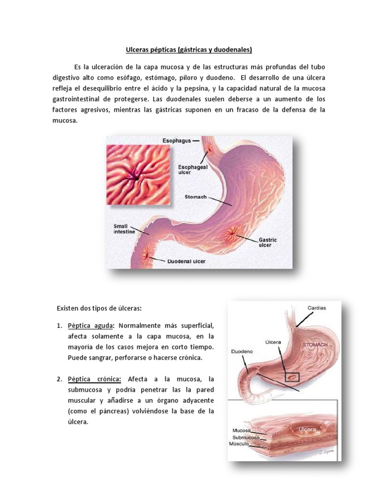 Tratamiento y tipos de úlceras pépticas | PDF | Úlcera péptica | Estómago