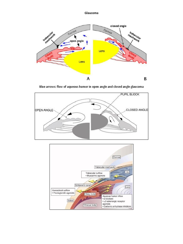 Understanding Glaucoma Types and Aqueous Flow | PDF