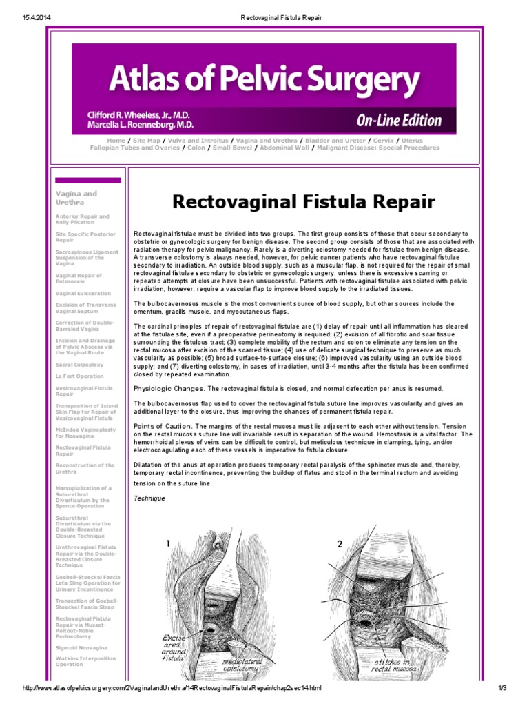 Rectovaginal Fistula Repair | PDF | Vagina | Rectum Rectovaginal Fistula Repair | PDF | Vagina | Rectum