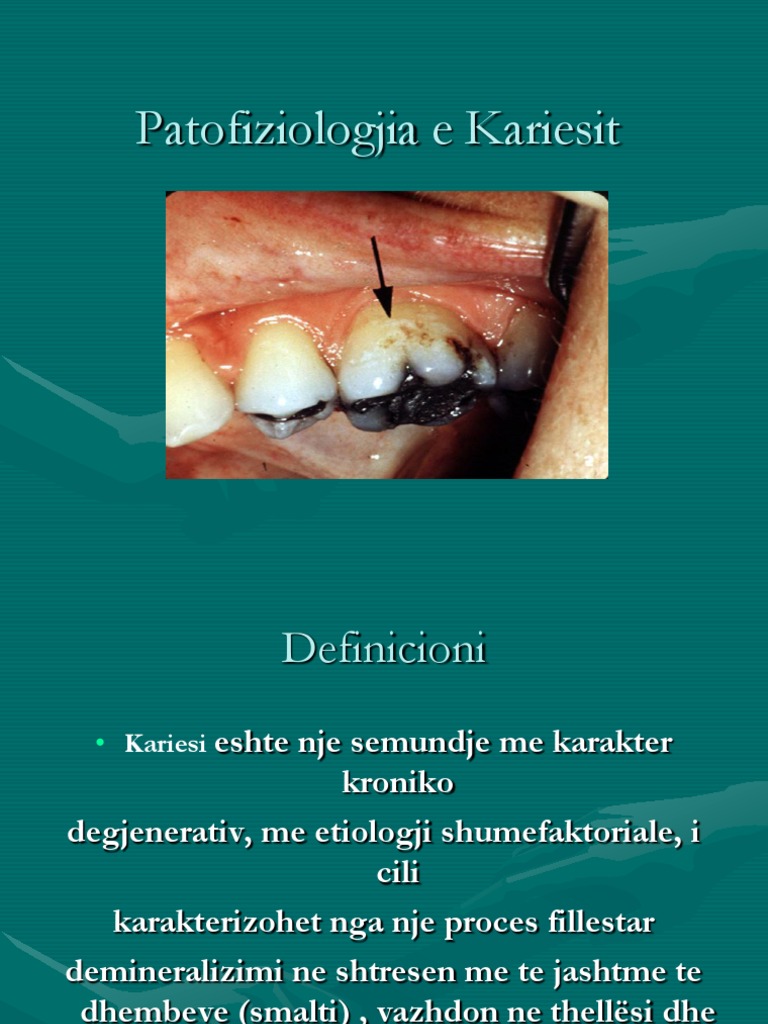 Pathophysiology of Dental Caries | PDF