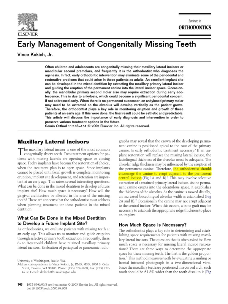 Management of Missing Teeth Kokich | PDF | Dental Implant | Tooth