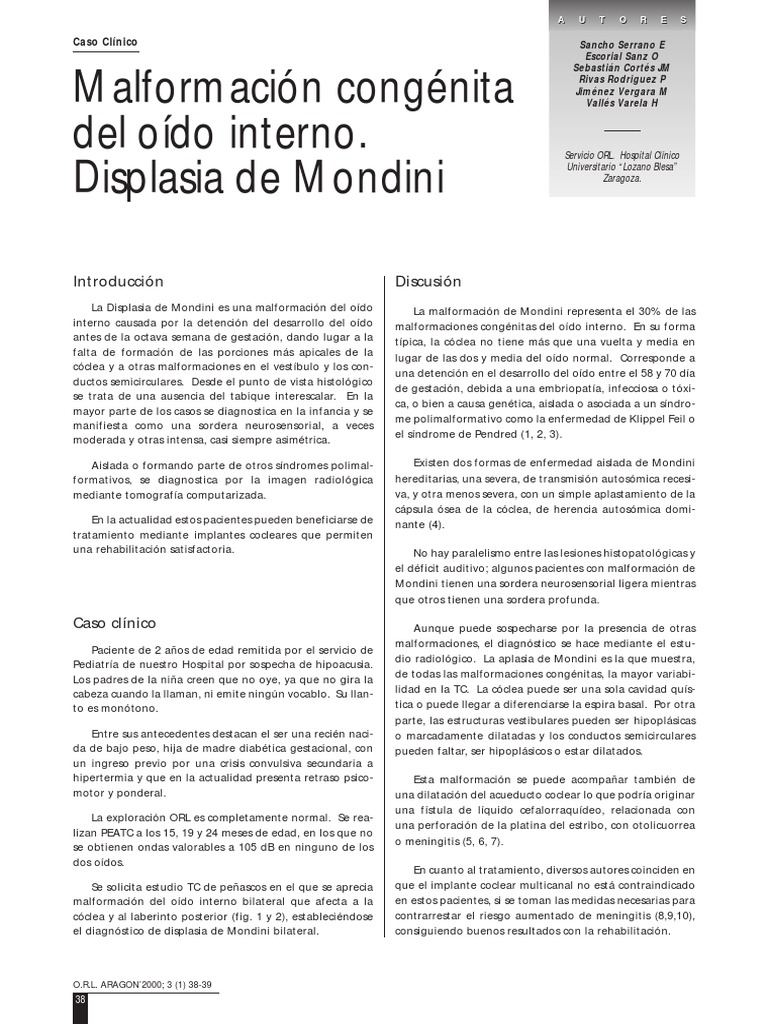 Displasia de Mondini | PDF