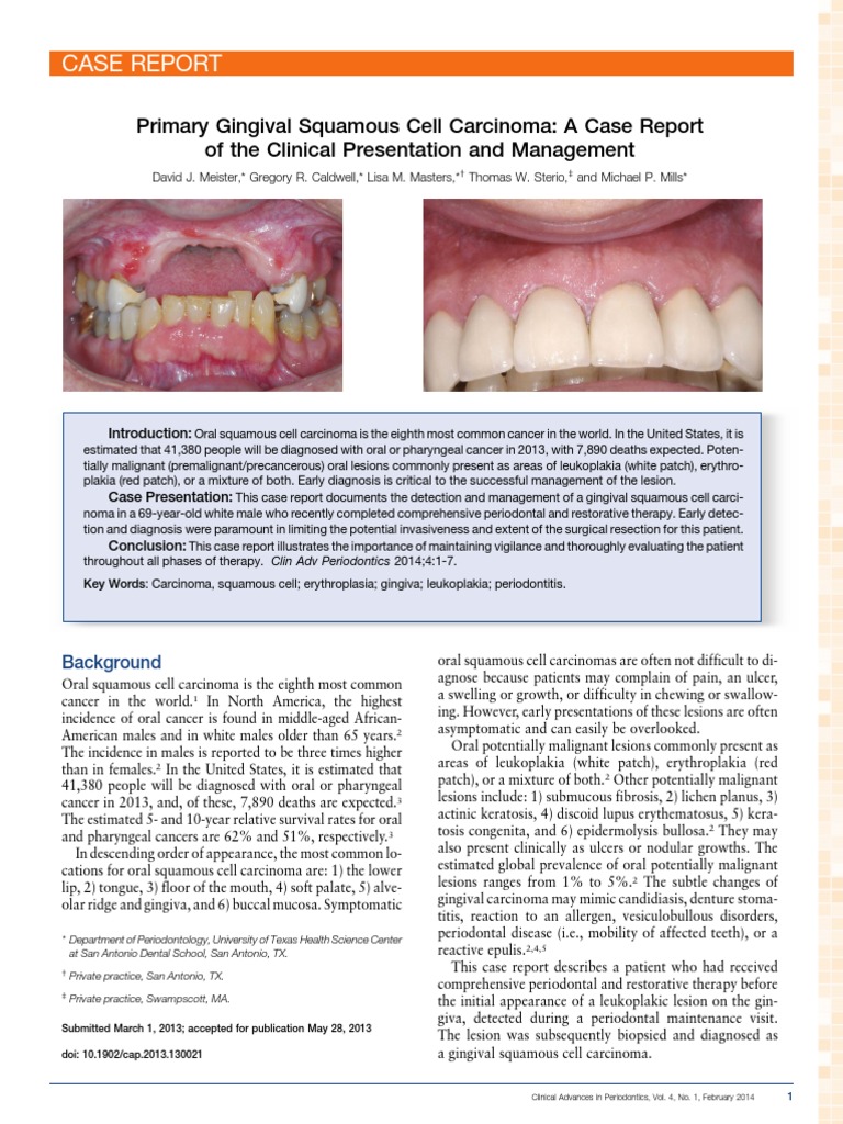 Primary Gingival Squamous Cell Carcinoma | Biopsy | Carcinoma
