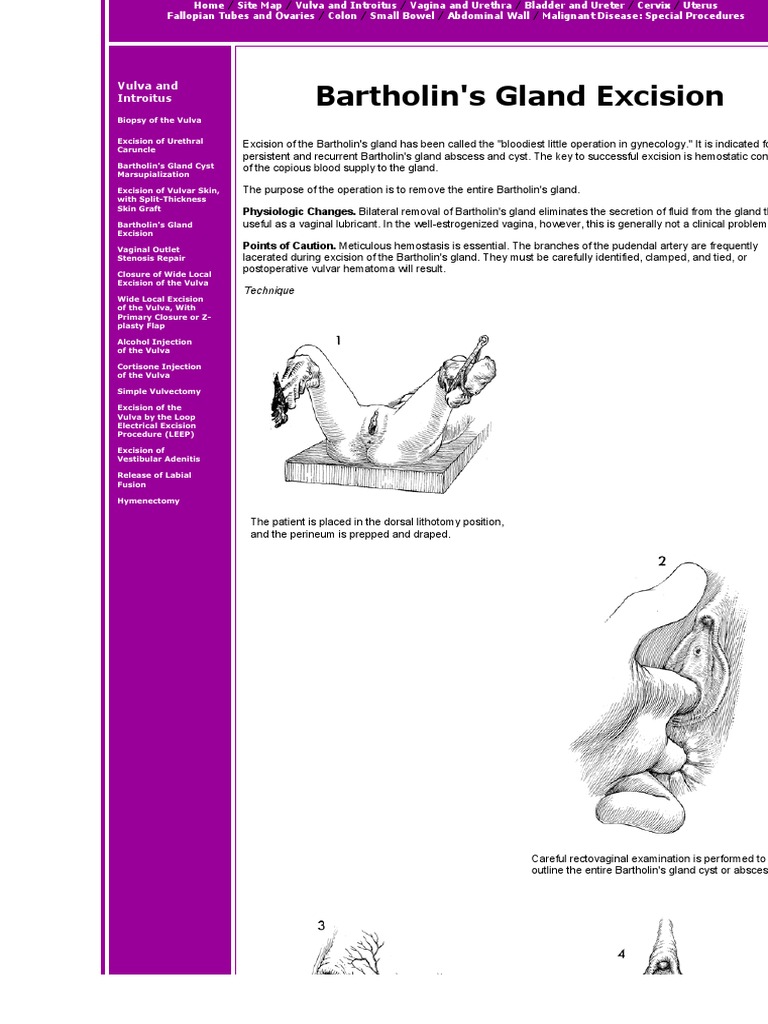 Bartholins Gland Excision Pdf Vagina Surgery