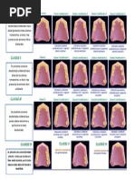 Grupo 1 Clasificacion de Kennedy, Reglas de Applegate | PDF | Dentadura ...