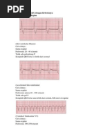 Aritmia Ekg Dengan Kriterianya | PDF