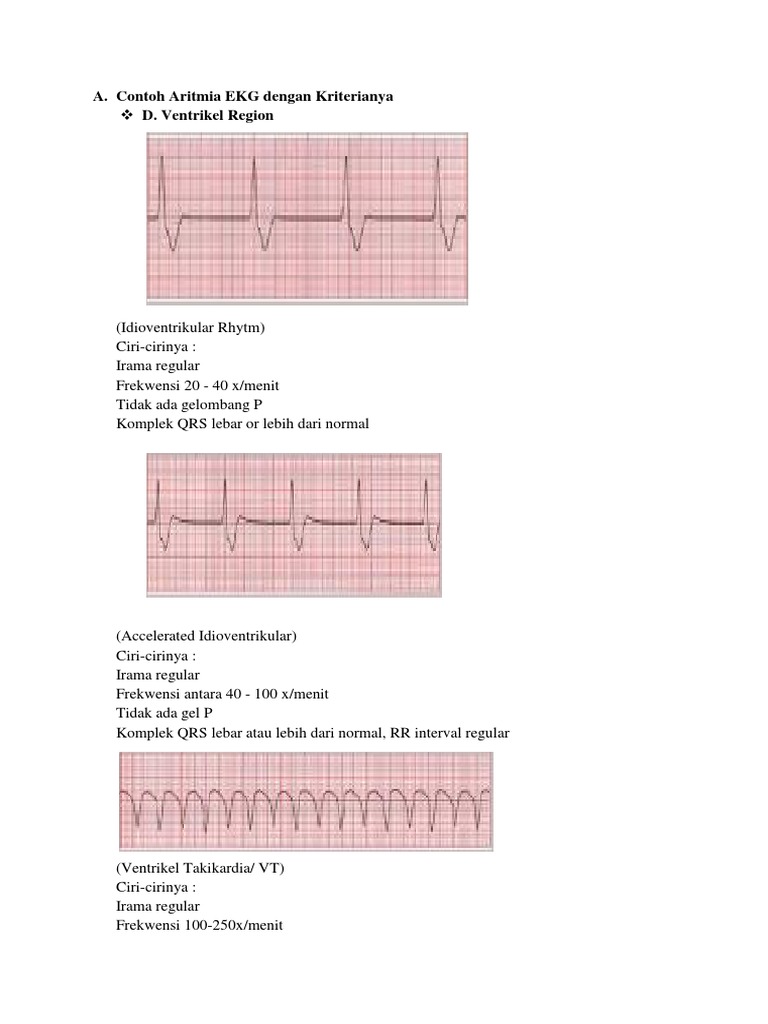Komplikasi Aritmia | PDF