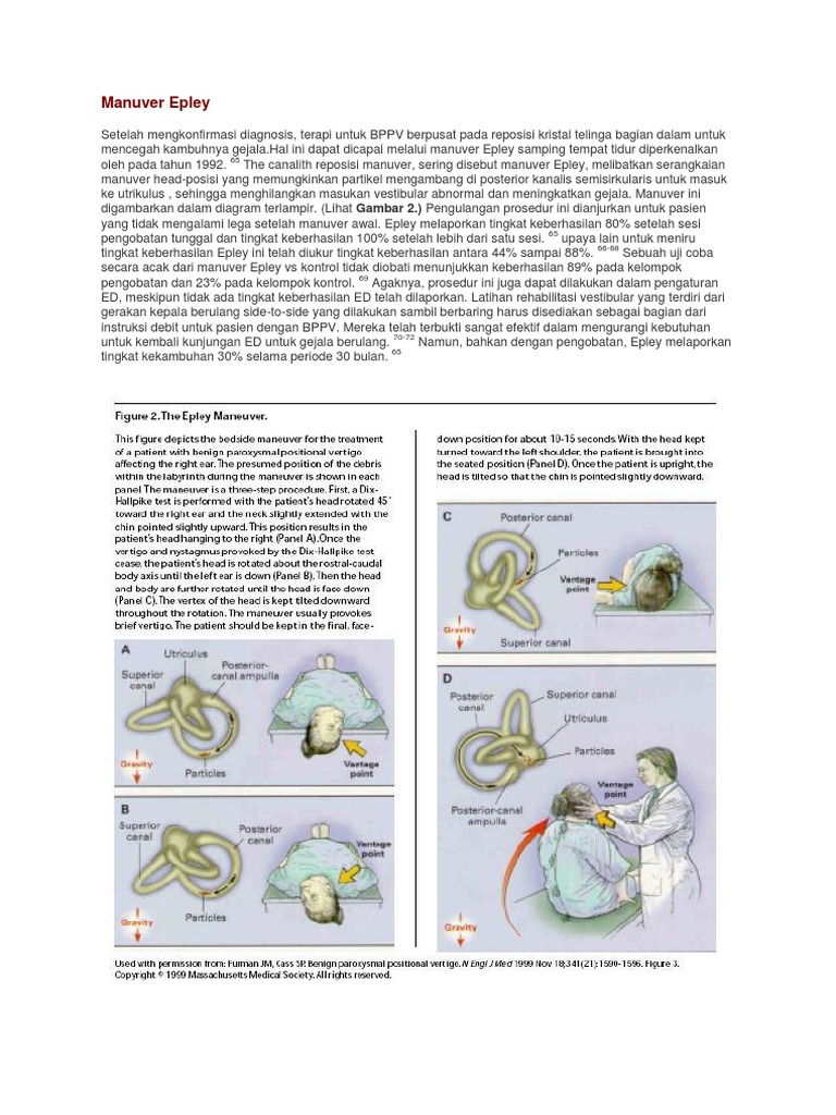 Manuver Epley untuk BPPV dan Efektivitasnya | PDF