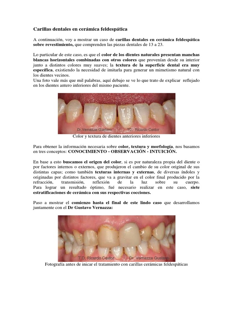Carillas Dentales en Cerámica Feldespática | PDF