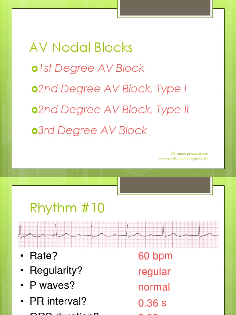 AV Nodal Blocks: 1st Degree AV Block 2nd Degree AV Block, Type I 2nd ...