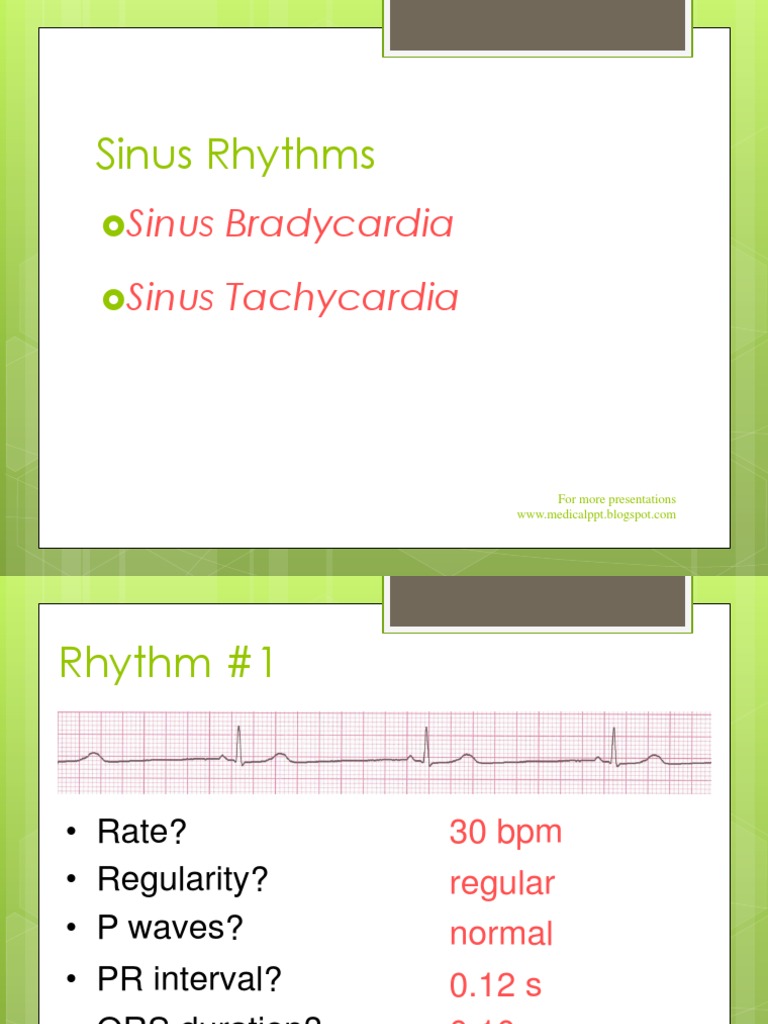 Sinus Brad, Tach, PAC, PVC | PDF | Cardiology | Heart