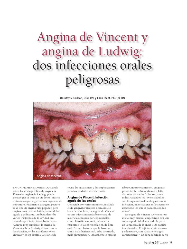 Angina de Vincent y de Ludwig | PDF | Diente humano | Higiene oral