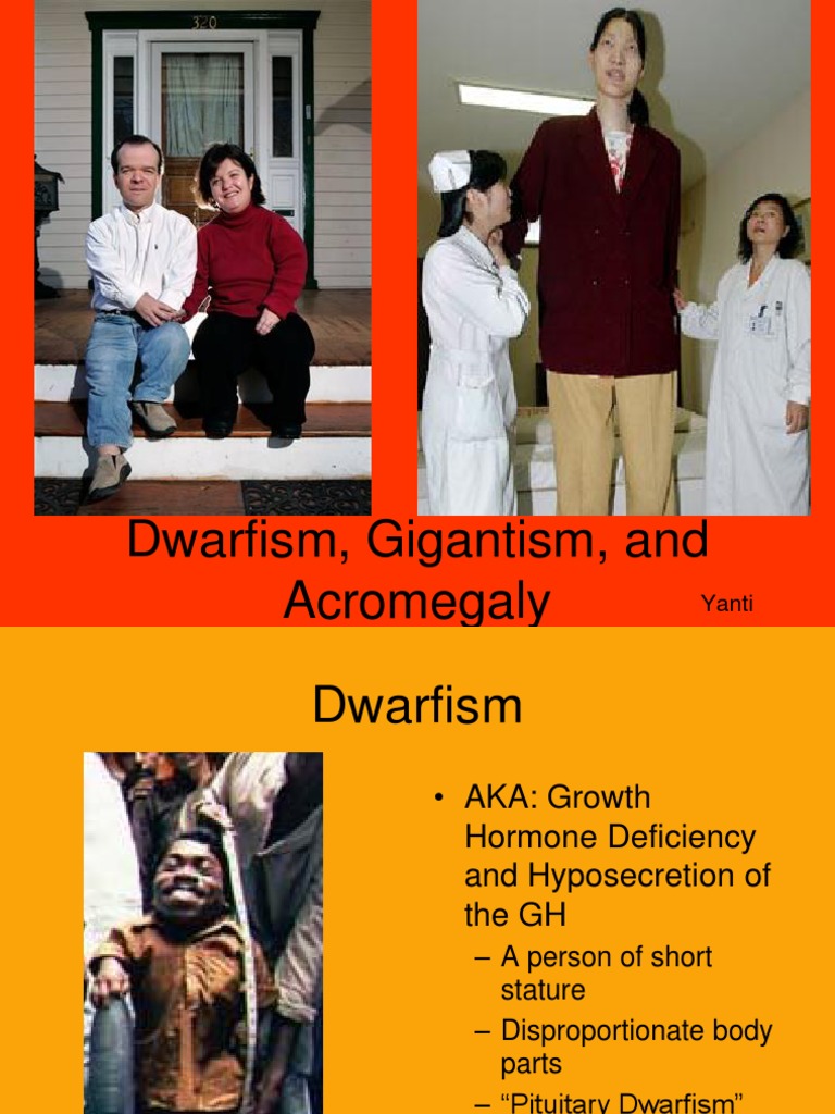 Gigantism And Dwarfism