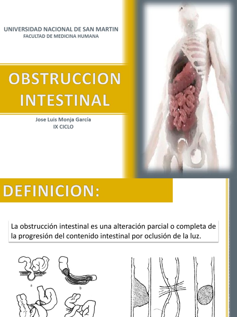 Obstruccion Intestinal