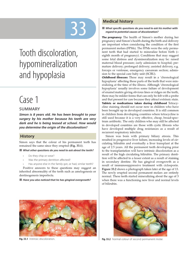 Tooth Discoloration Hypomineralization and Hypoplasia | Halitosis ...