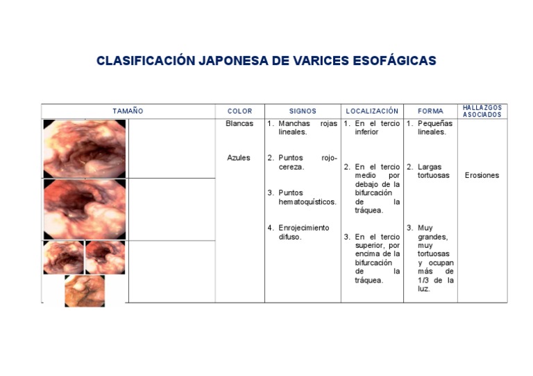 Clasificación Japonesa de Varices Esofágicas