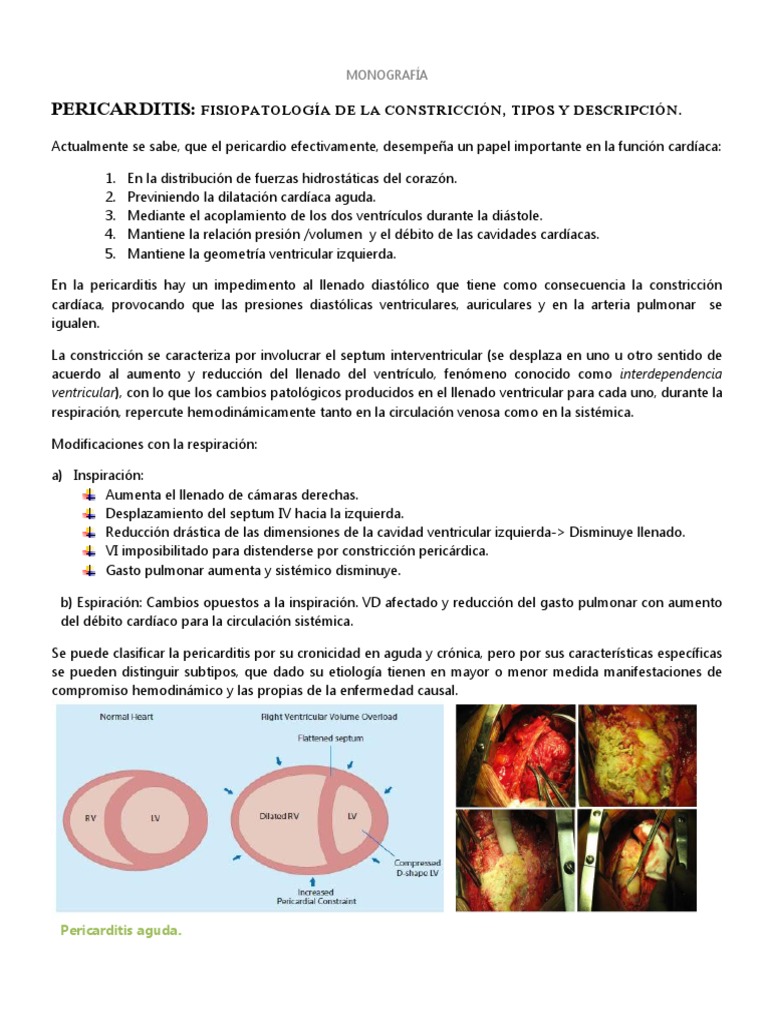 Pericarditis:: Fisiopatología De La Constricción, Tipos Y Descripción