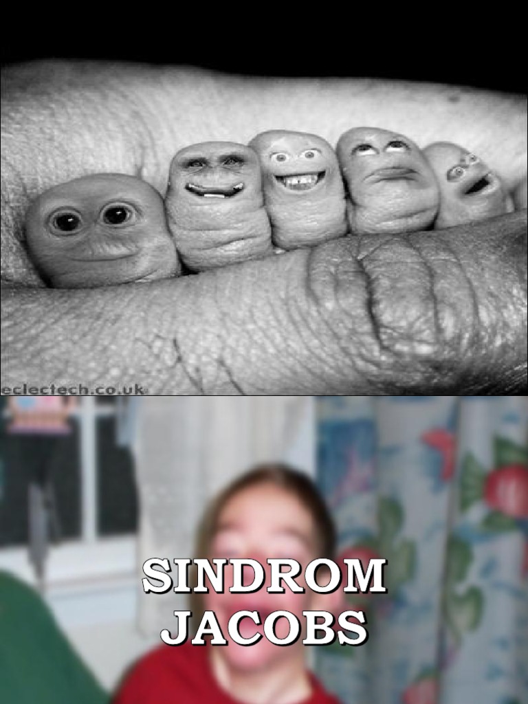 Sindrom Jacobs Baruuu | PDF