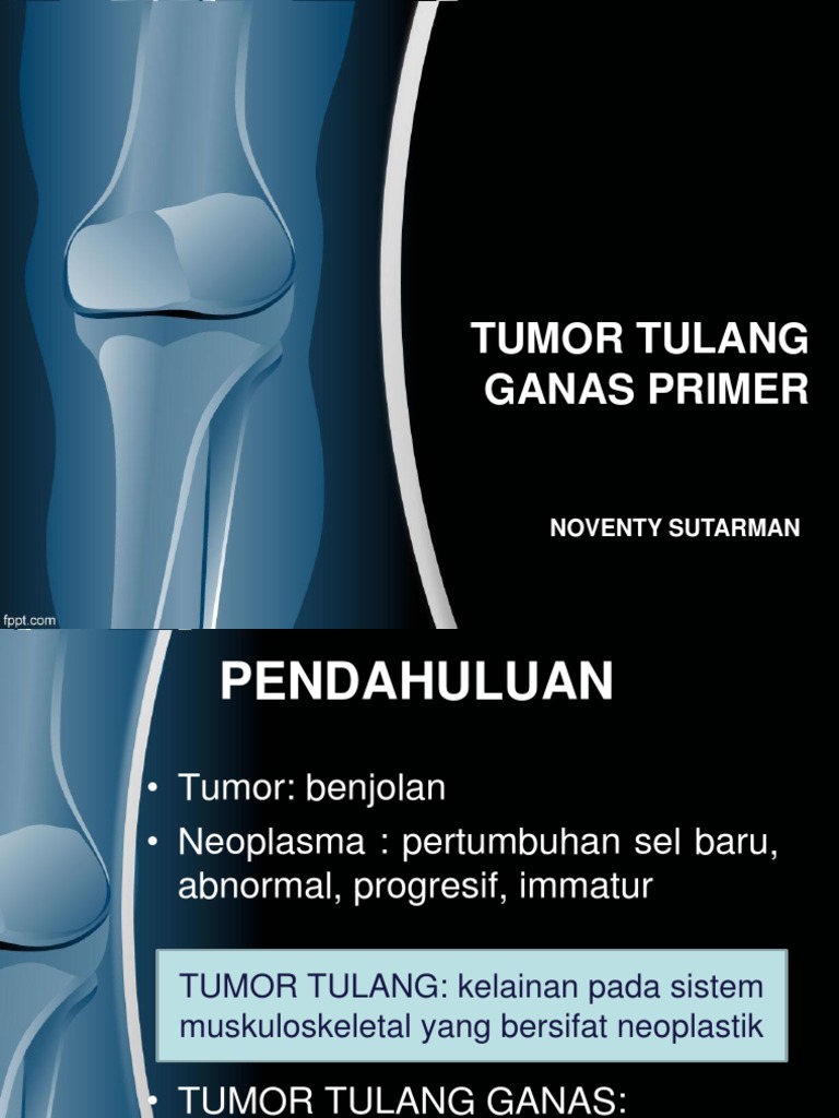 Tumor Tulang Ganas | PDF