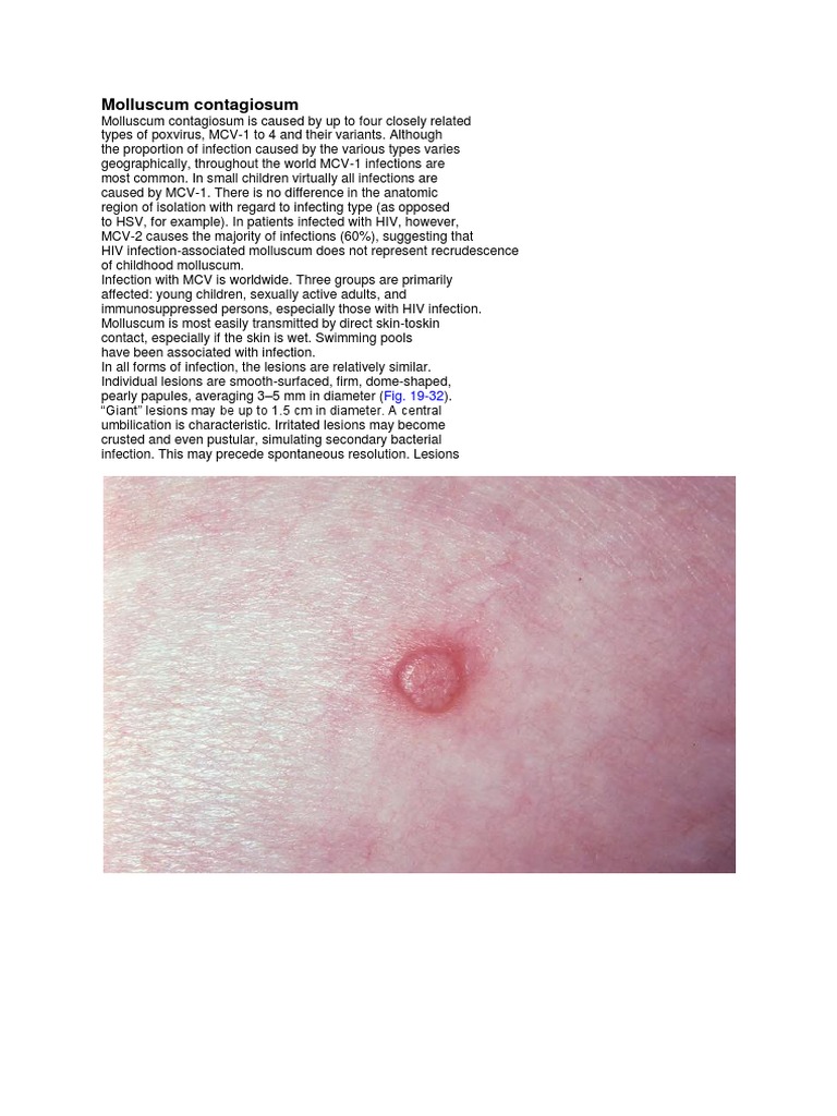 Molluscum Contagiosum Andrew N Pitzpatrick | Dermatitis | Infection