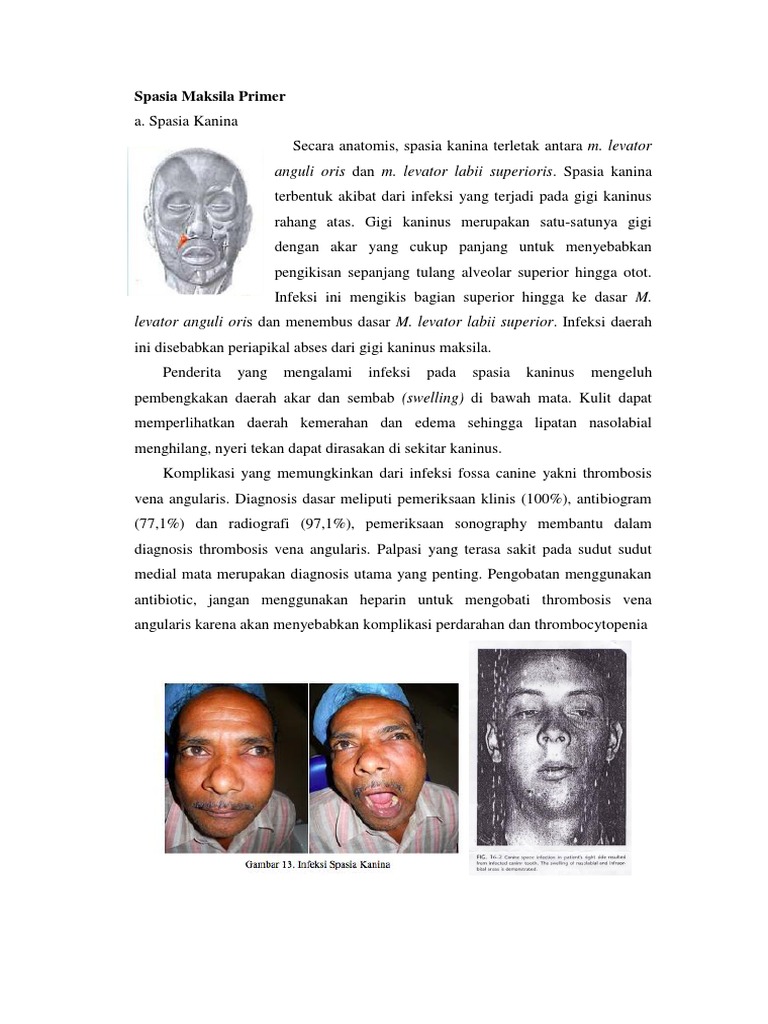 Abses Spasia Maxilla | PDF