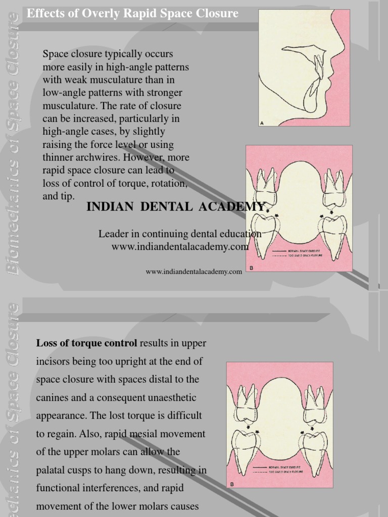 Space Closure3 / Orthodontic Courses by Indian Dental Academy | PDF ...
