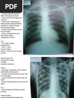Evaluasi Foto Thorax Normal | PDF