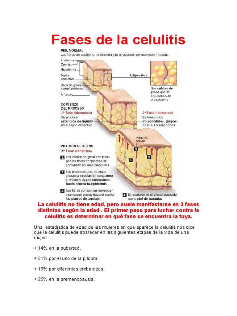 Fases de La Celulitis y Tratamiento | PDF
