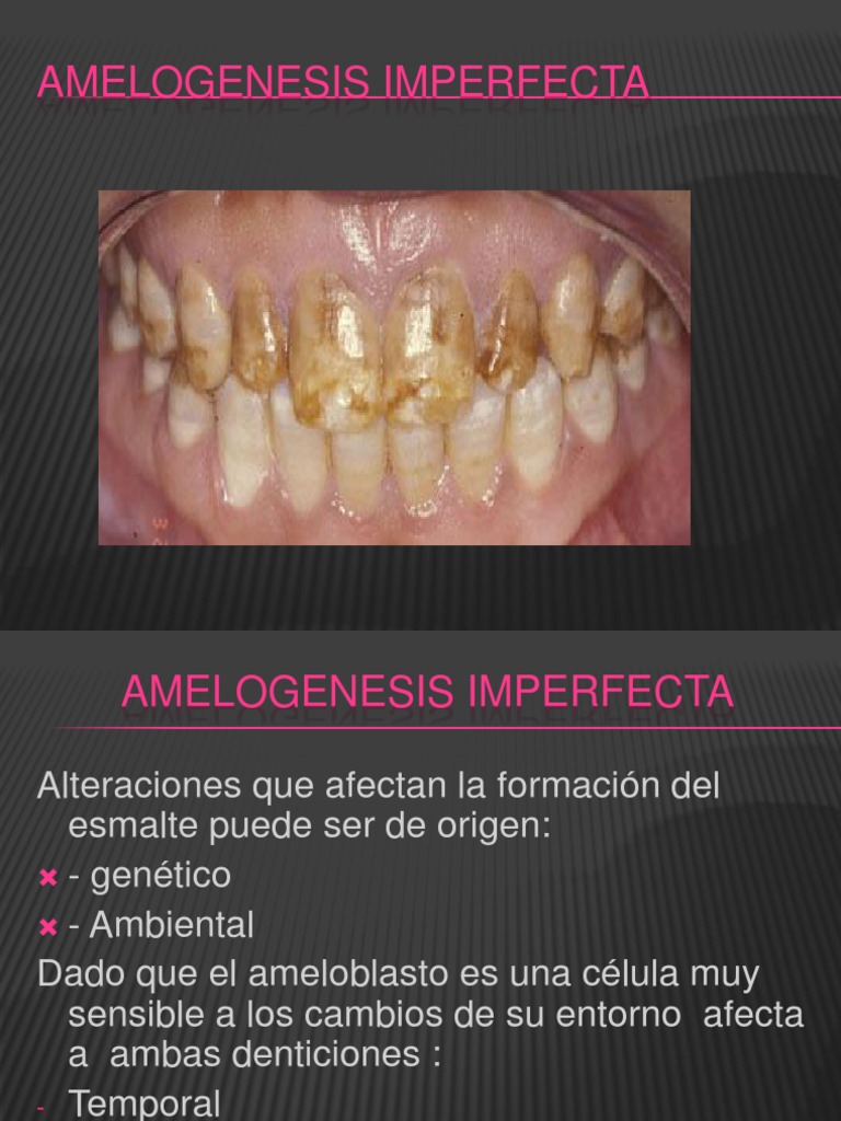 Amelogenesis Imperfecta